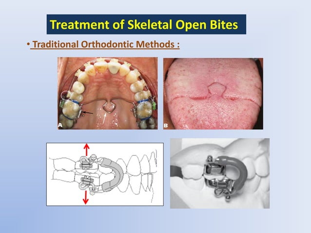 Anterior open bite treatment in the permanent dentition part 2- | PDF