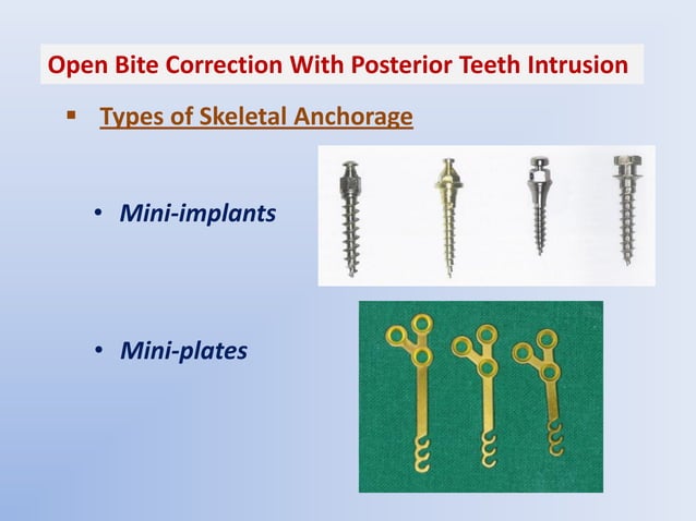 Anterior open bite treatment in the permanent dentition part 2- | PDF