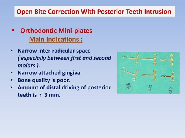 Anterior open bite treatment in the permanent dentition part 2- | PDF