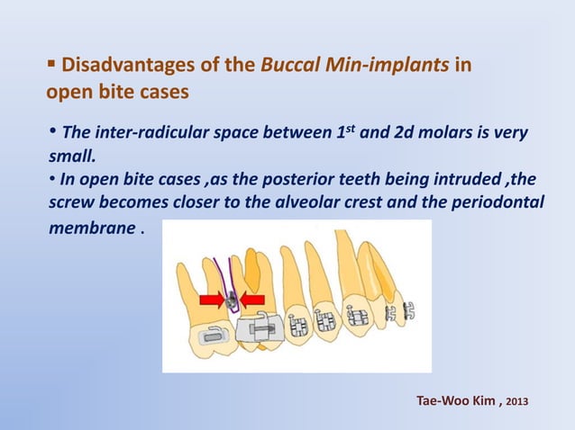 Anterior open bite treatment in the permanent dentition part 2- | PDF