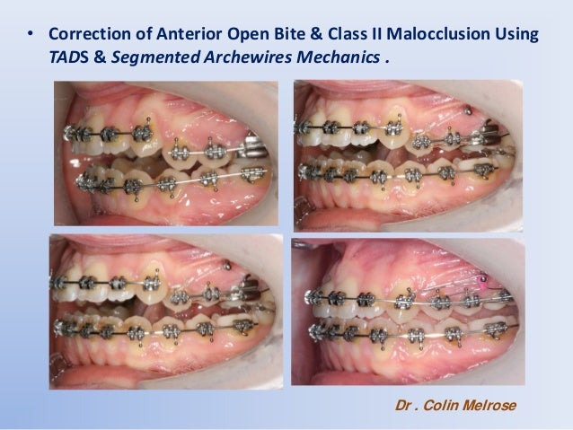 Anterior open bite treatment in the permanent dentition part 2-