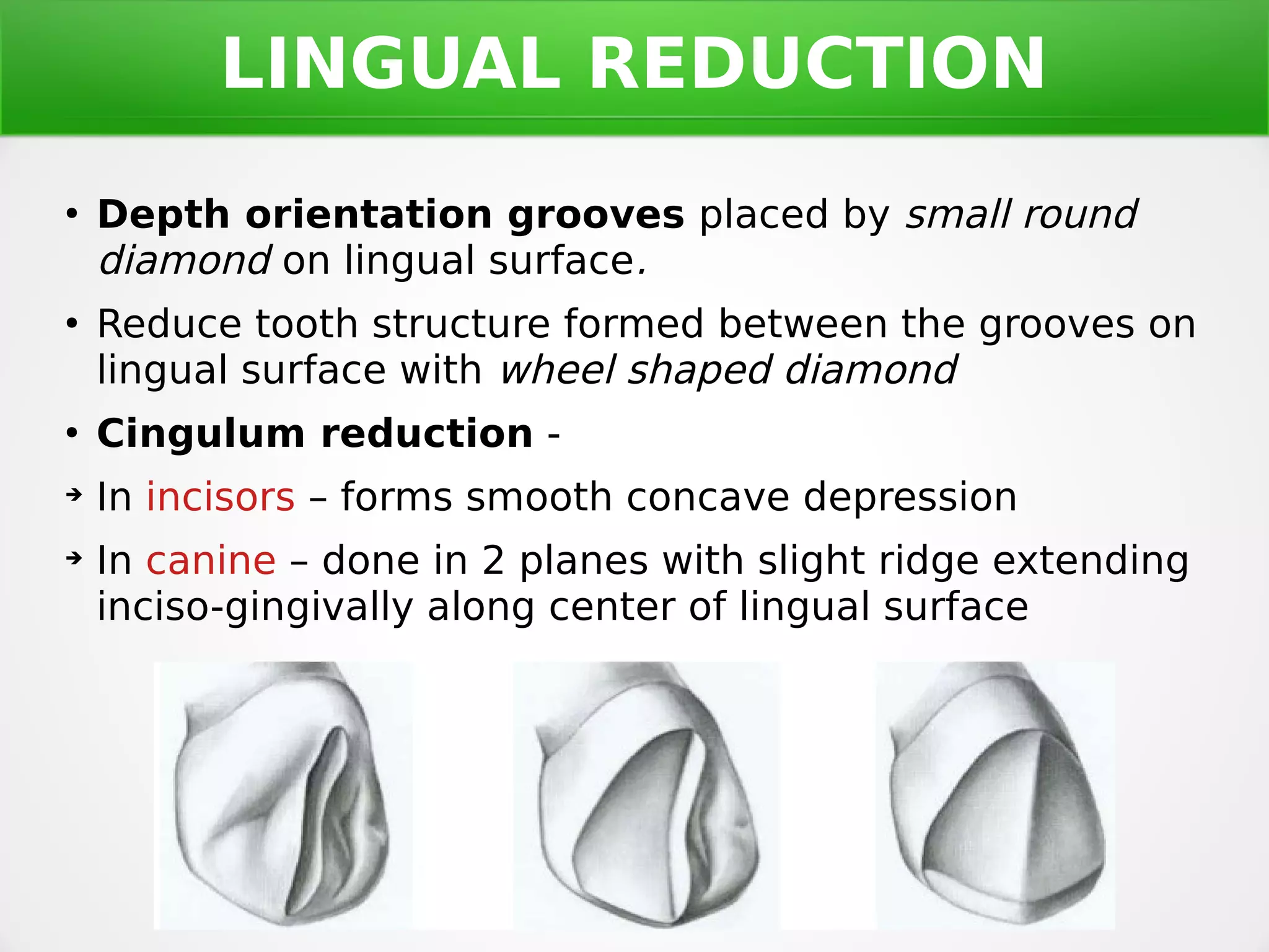 Anterior Partial Veneer crown preparation | PDF