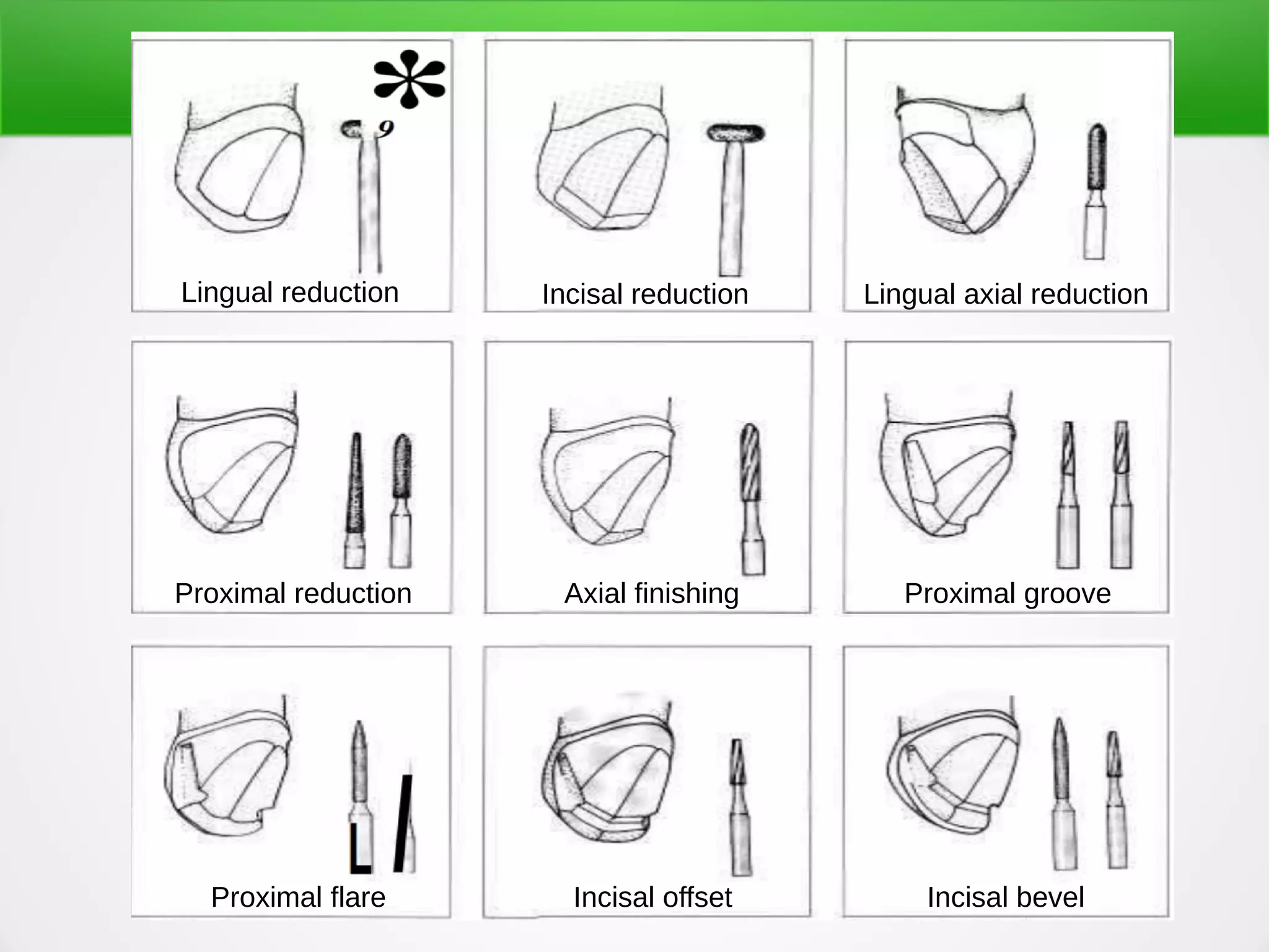Anterior Partial Veneer crown preparation | PDF