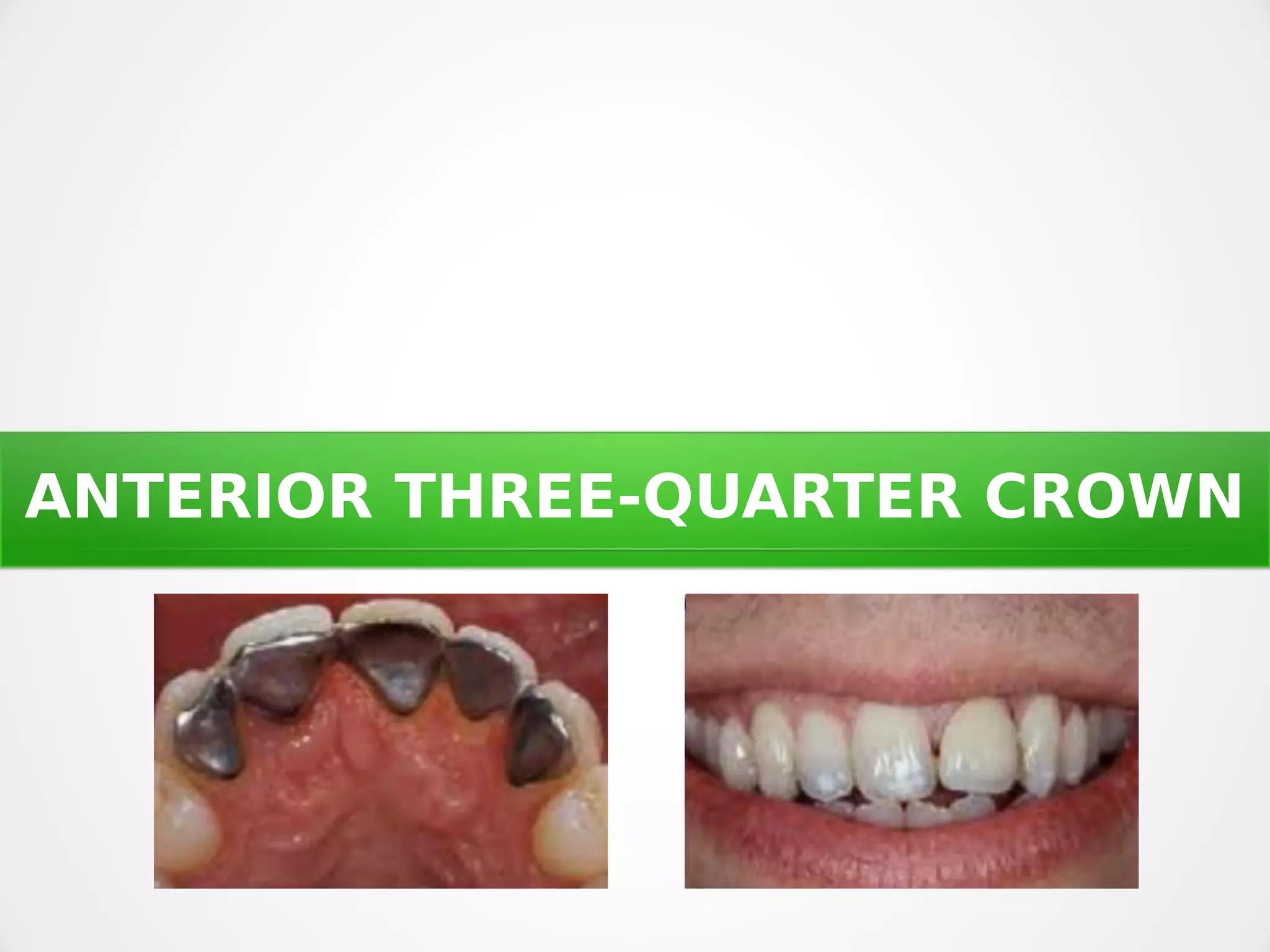 Anterior Partial Veneer crown preparation | PDF