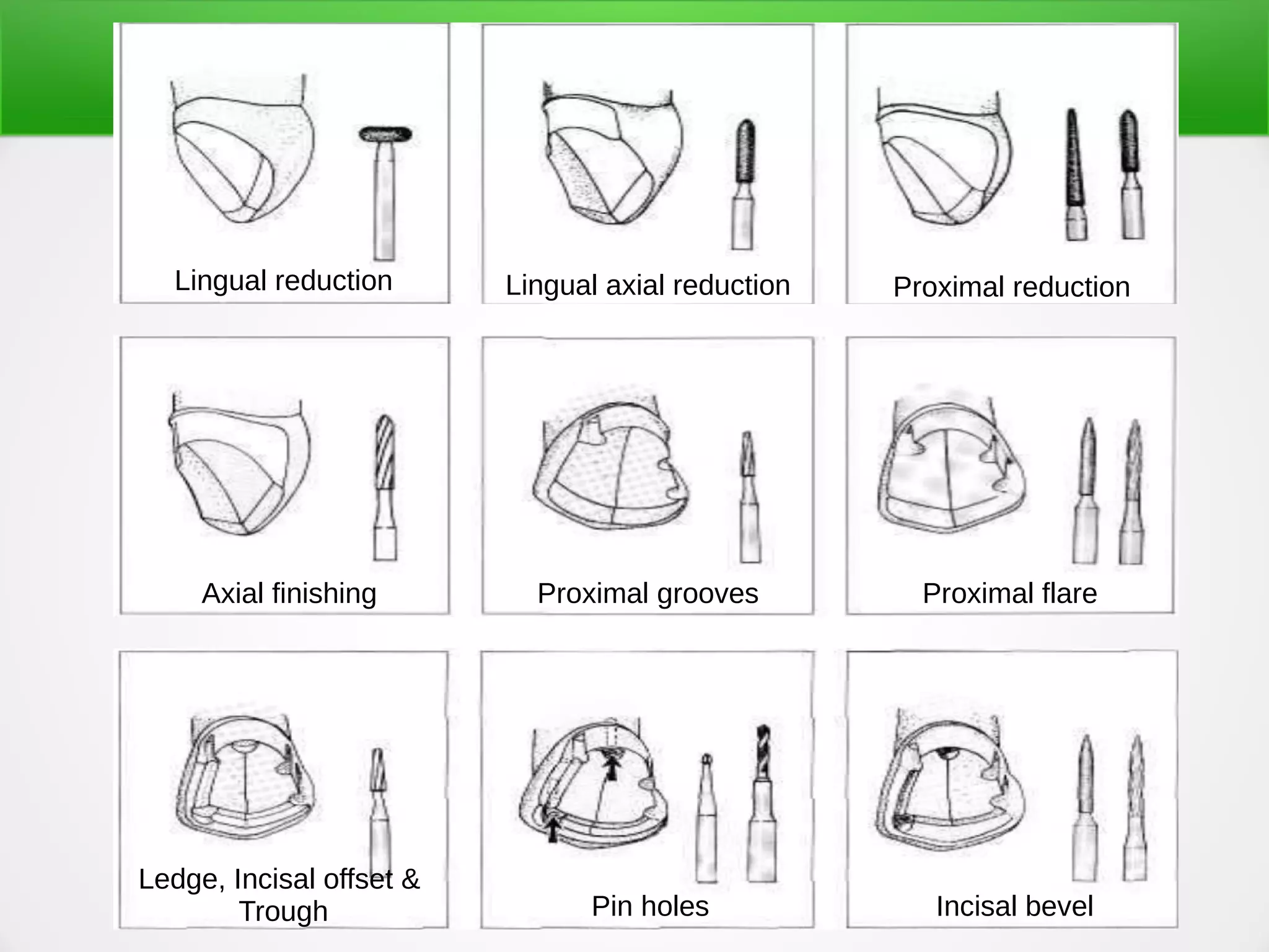 Anterior Partial Veneer crown preparation | PDF