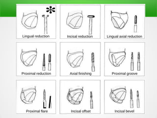 Anterior Partial Veneer crown preparation | PDF