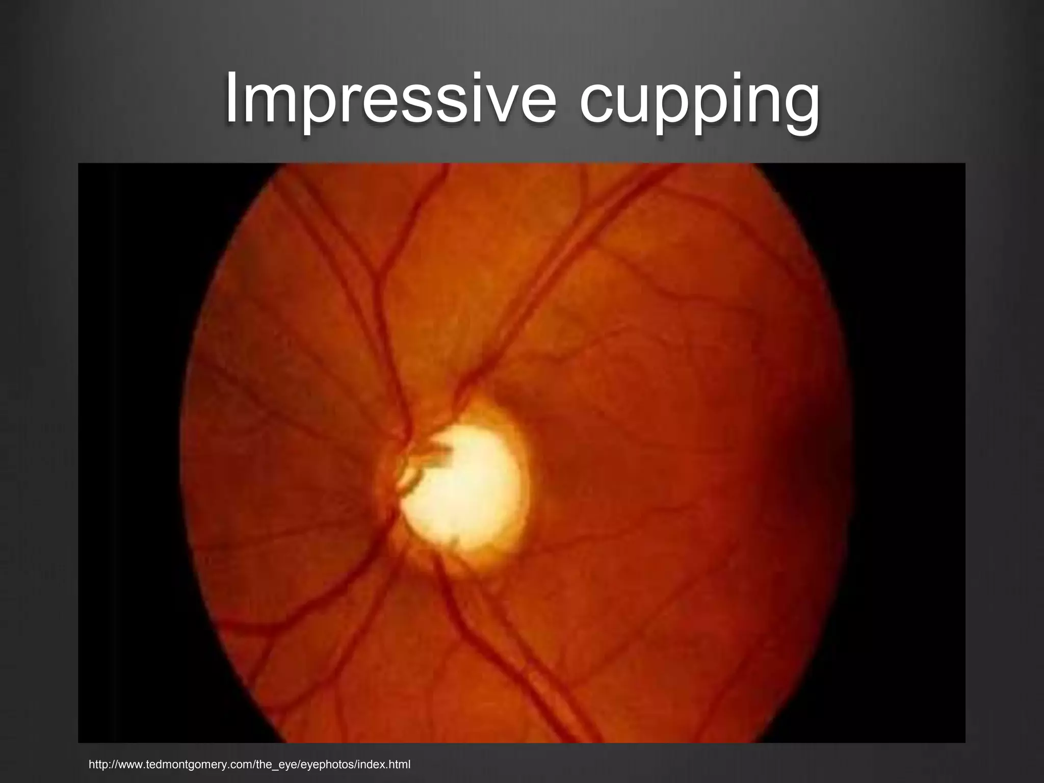 Anterior Pole - Dr. Scott Burdette | PPTX