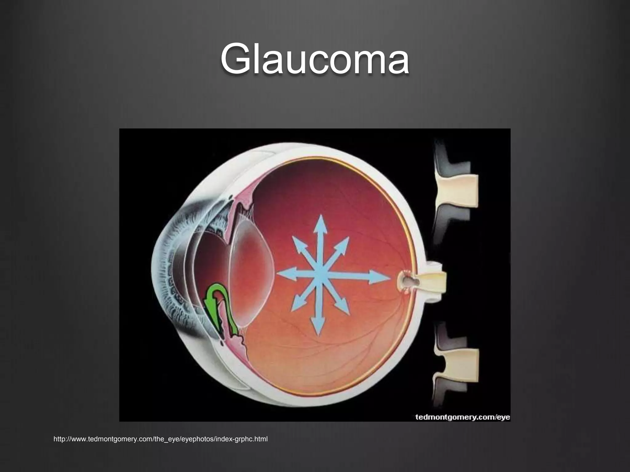 Anterior Pole - Dr. Scott Burdette | PPTX