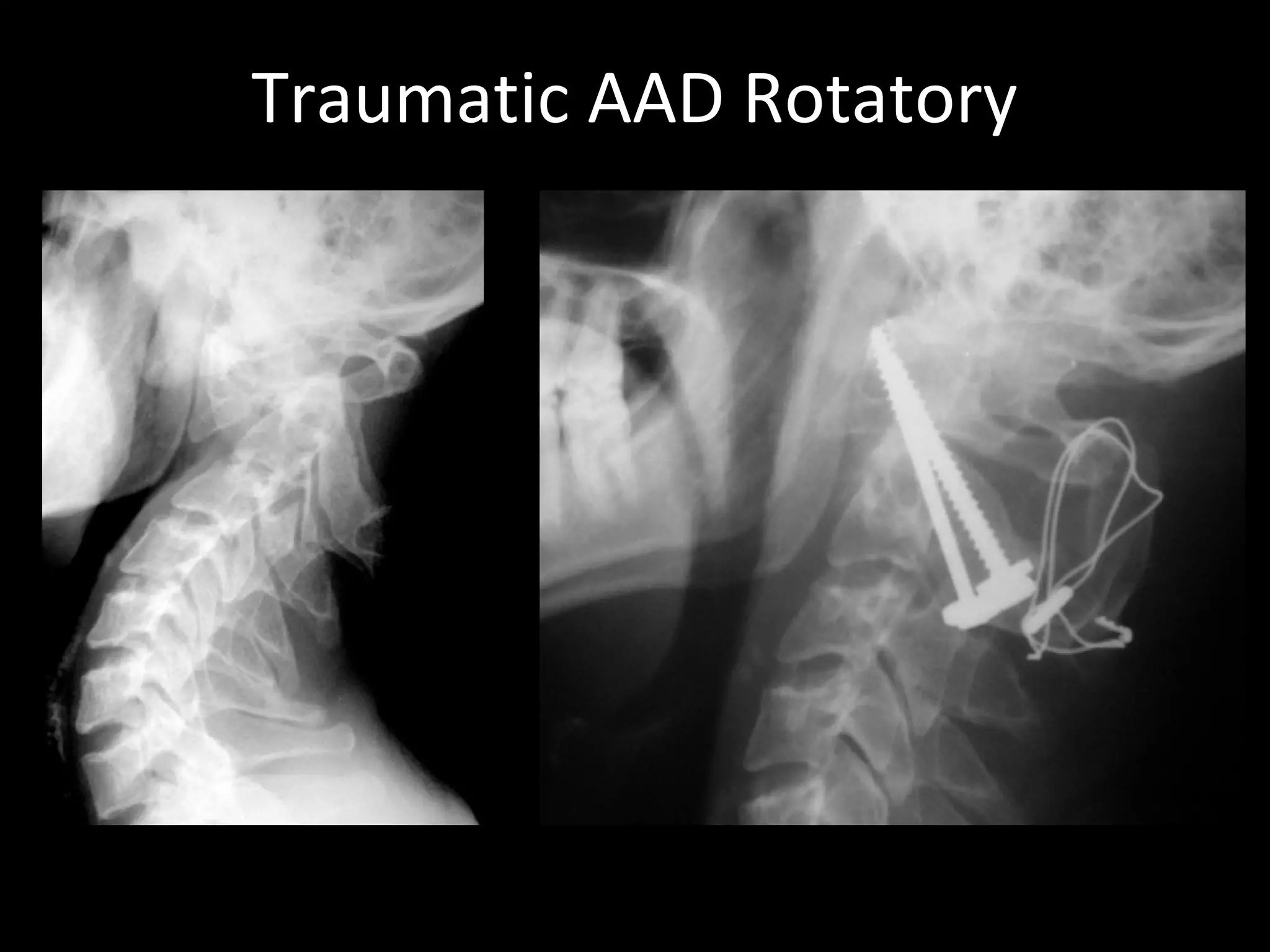 Anterior transoral atlantoaxial release and posterior instrumented ...