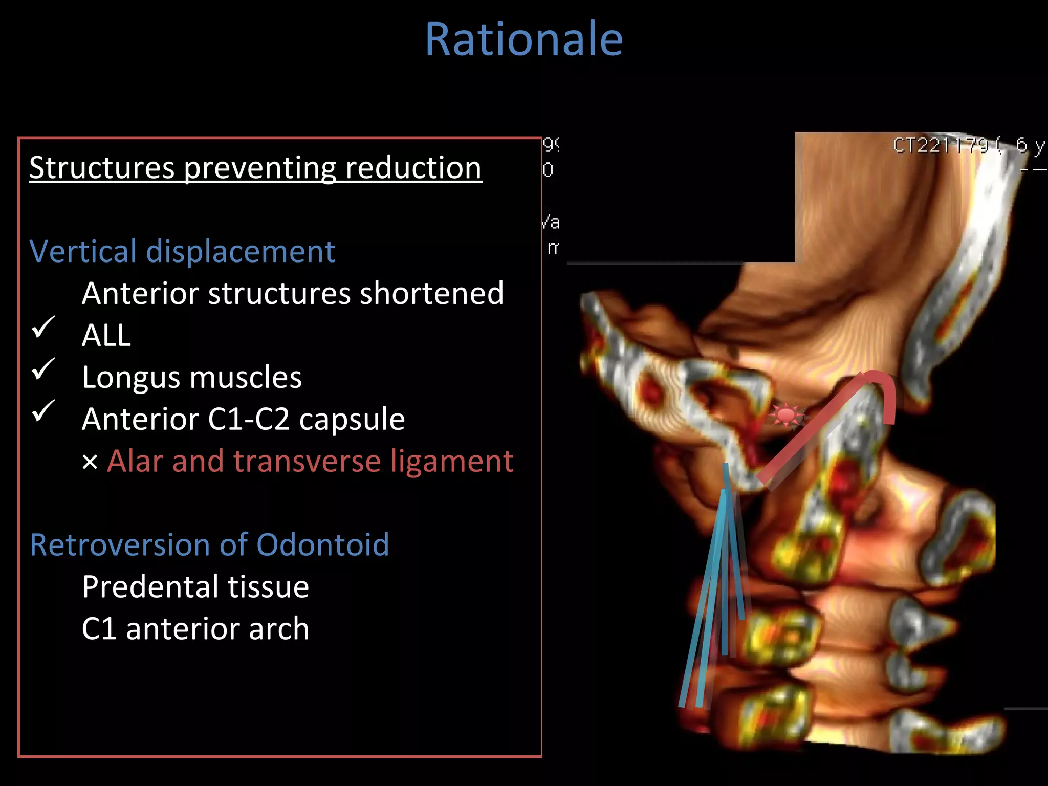 Anterior transoral atlantoaxial release and posterior instrumented ...