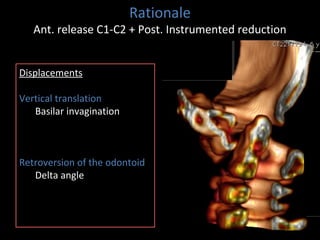 Anterior transoral atlantoaxial release and posterior instrumented ...