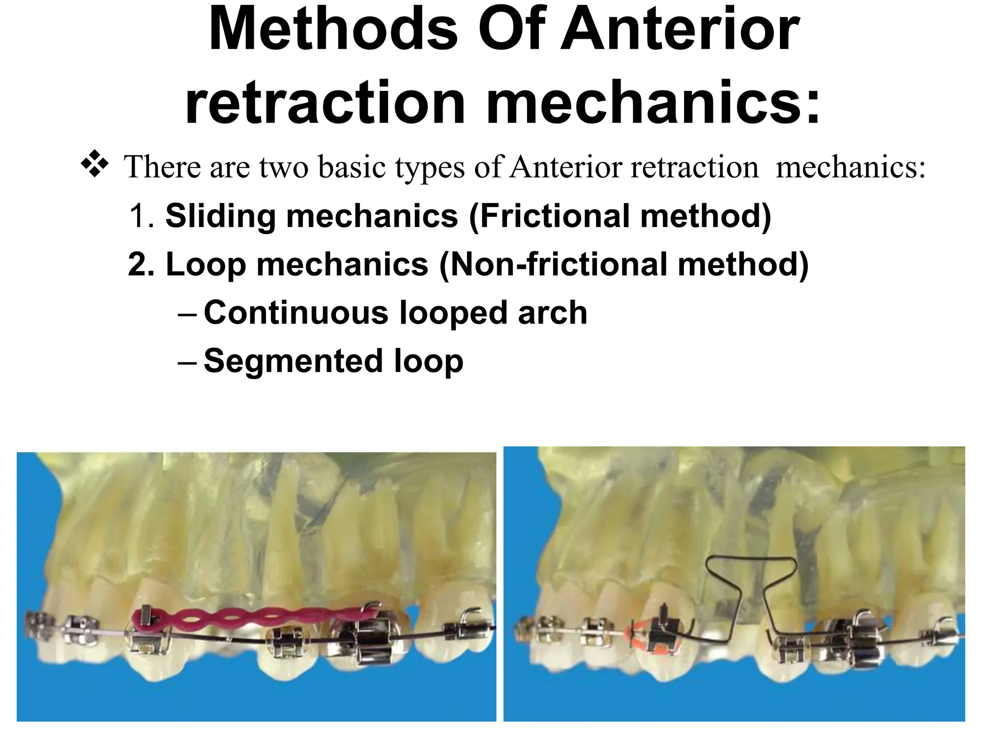 ANTERIOR RETRACTION MECHANICs in orthodonticsS 1.pptx