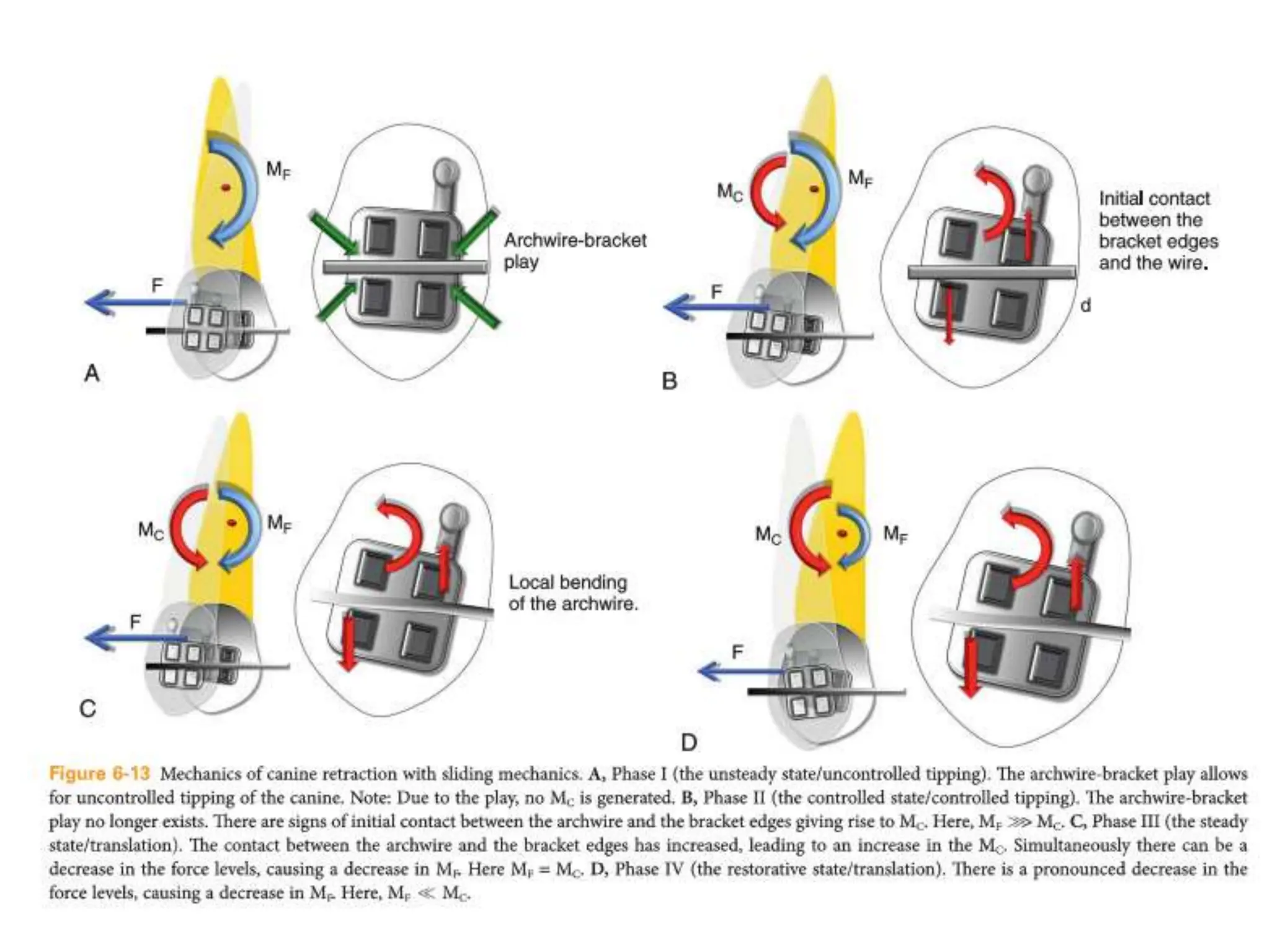 ANTERIOR RETRACTION MECHANICs in orthodonticsS 1.pptx