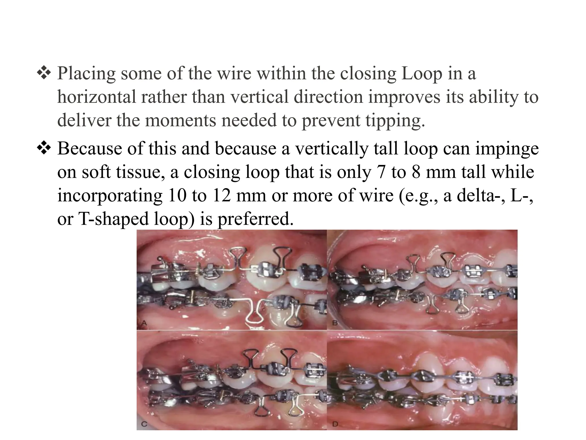 ANTERIOR RETRACTION MECHANICs in orthodonticsS 1.pptx