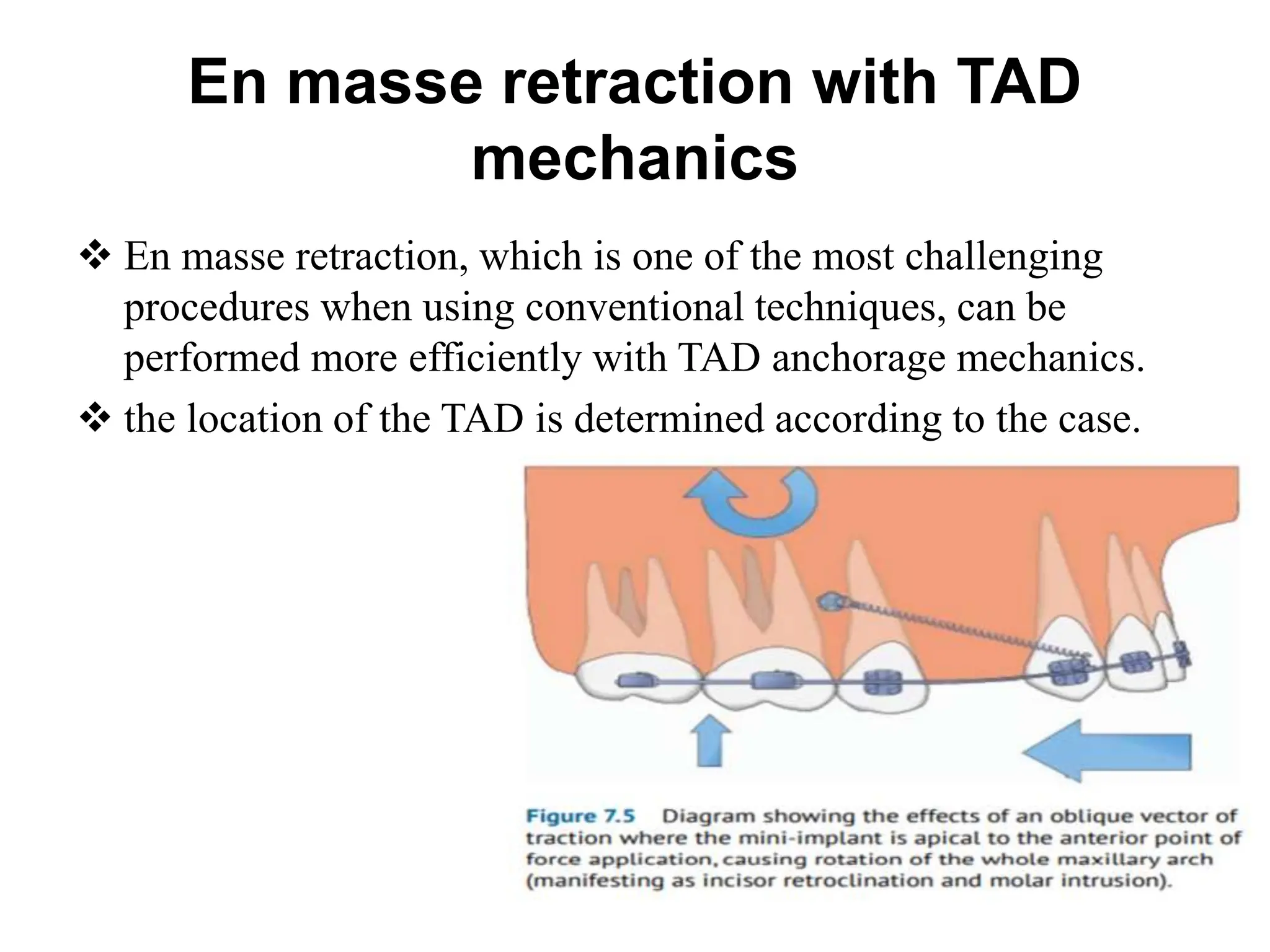 ANTERIOR RETRACTION MECHANICs in orthodonticsS 1.pptx