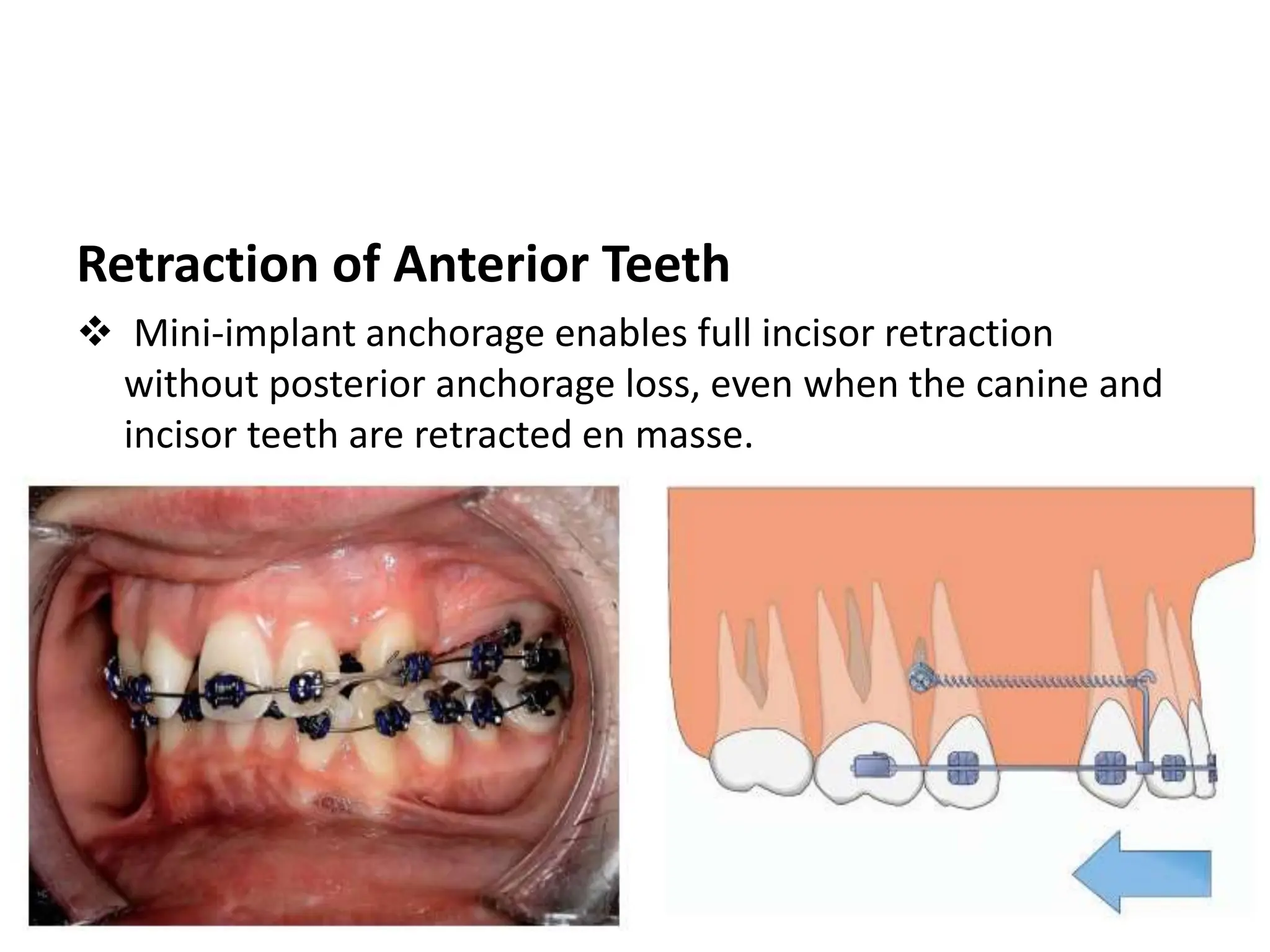 ANTERIOR RETRACTION MECHANICs in orthodonticsS 1.pptx