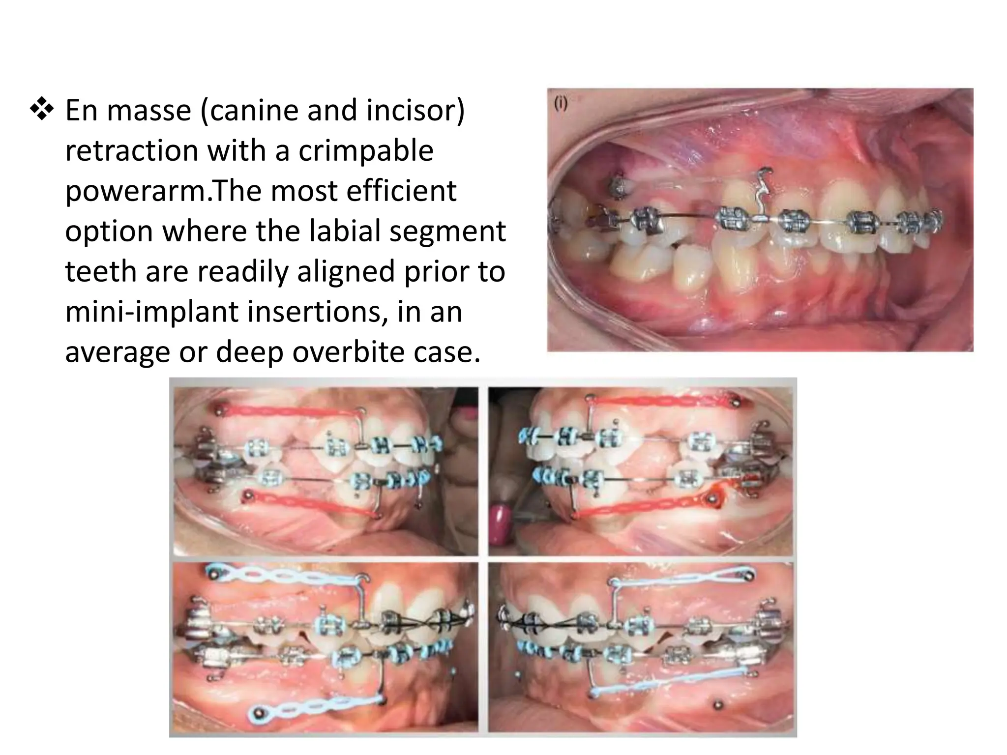 ANTERIOR RETRACTION MECHANICs in orthodonticsS 1.pptx