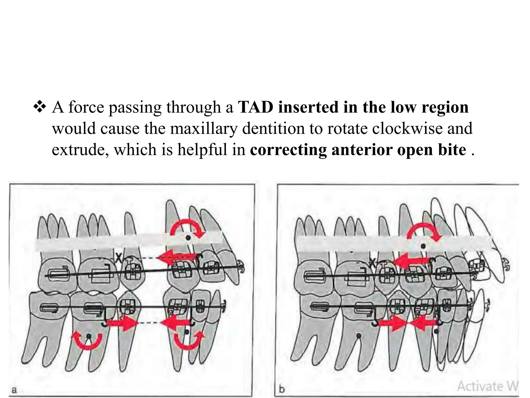 ANTERIOR RETRACTION MECHANICs in orthodonticsS 1.pptx