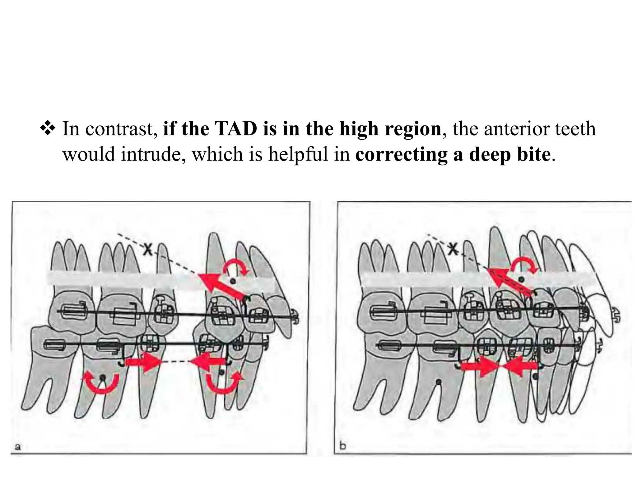 ANTERIOR RETRACTION MECHANICs in orthodonticsS 1.pptx