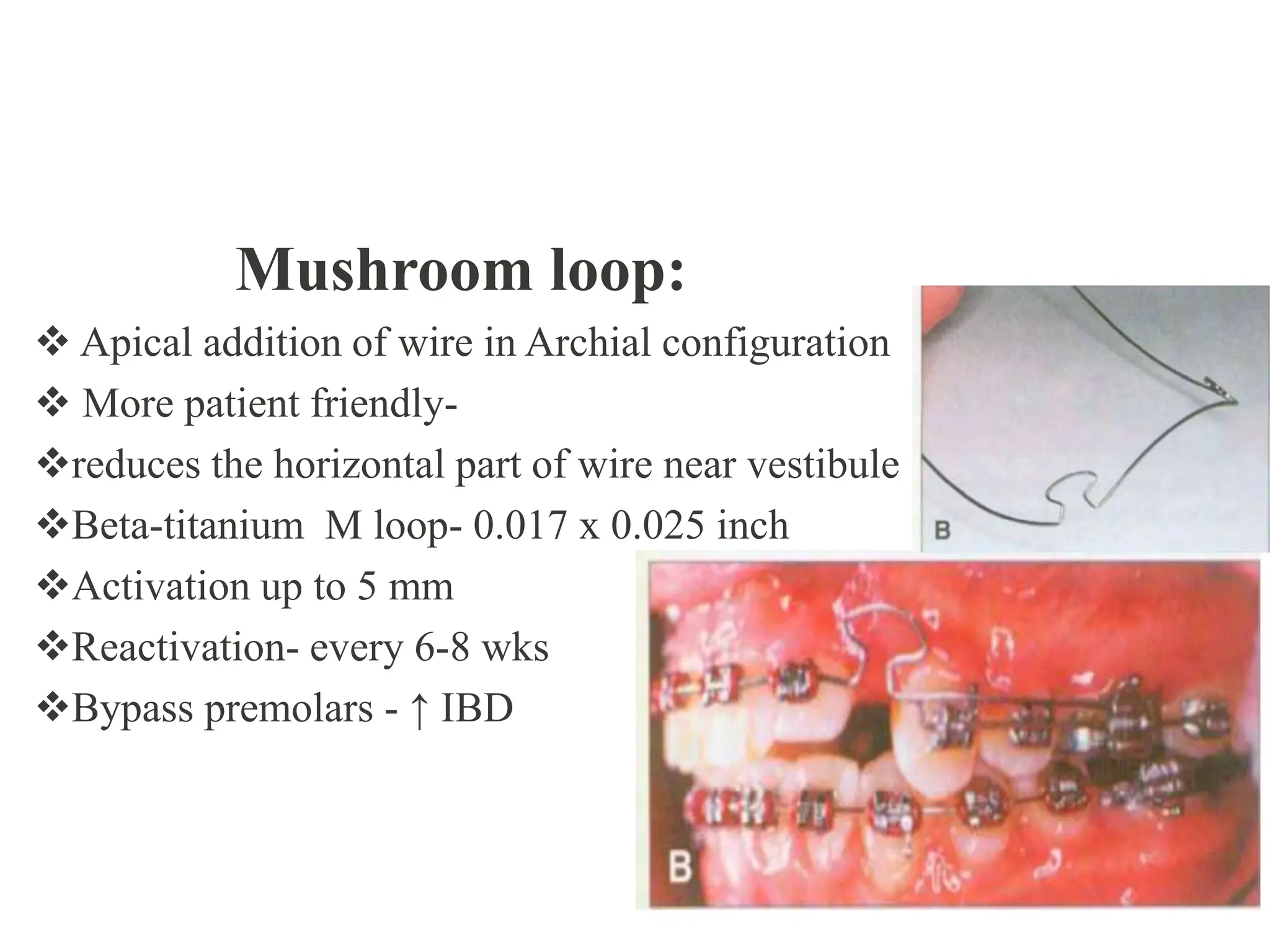 ANTERIOR RETRACTION MECHANICs in orthodonticsS 1.pptx