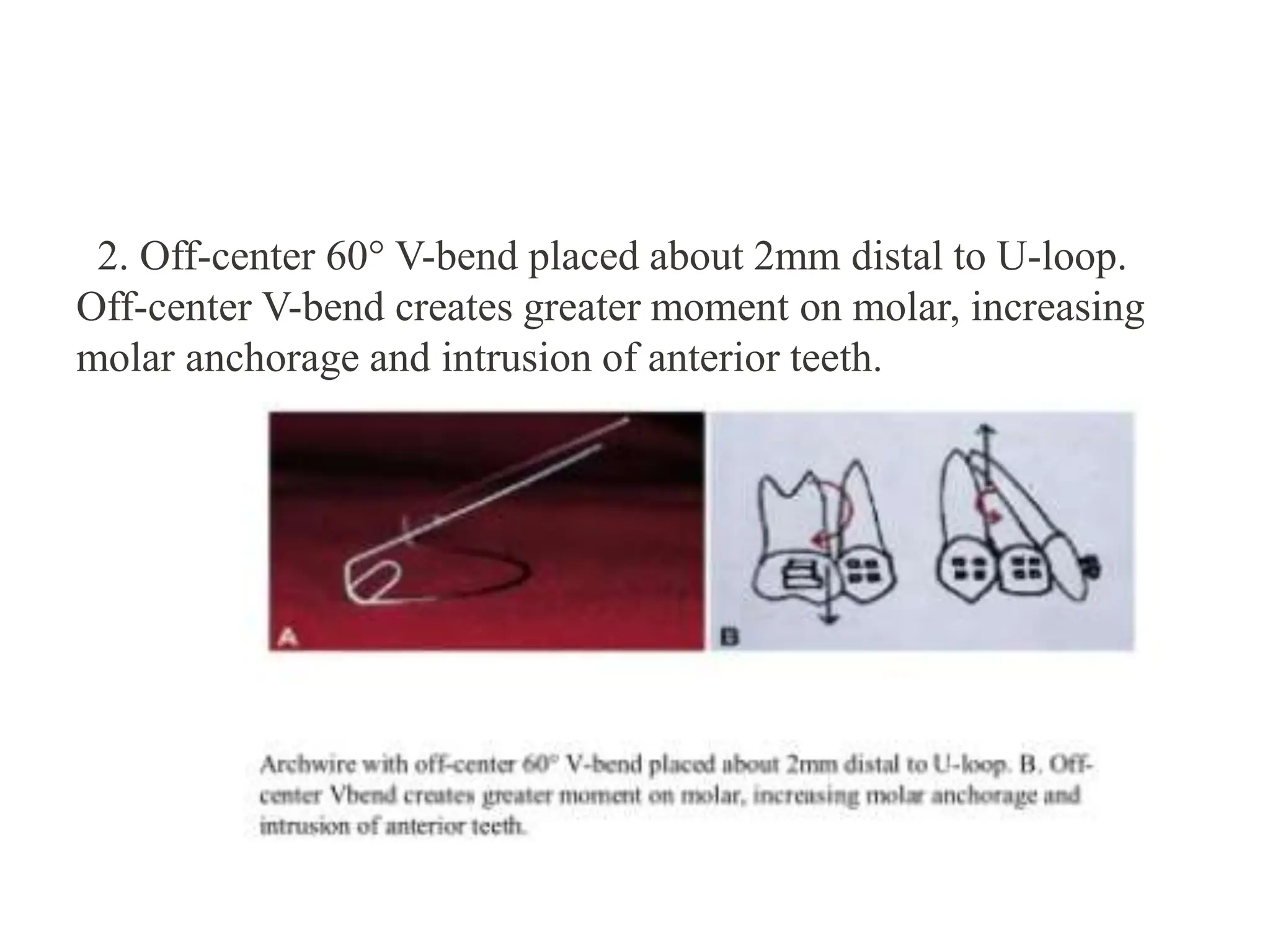 ANTERIOR RETRACTION MECHANICs in orthodonticsS 1.pptx