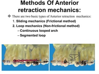 ANTERIOR RETRACTION MECHANICs in orthodonticsS 1.pptx