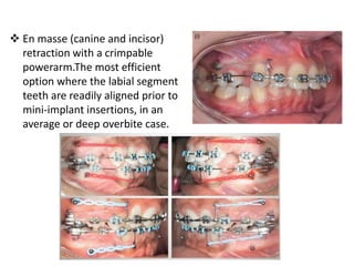 ANTERIOR RETRACTION MECHANICs in orthodonticsS 1.pptx