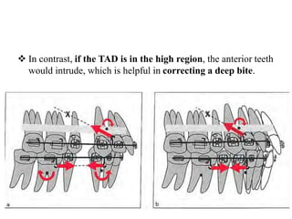 ANTERIOR RETRACTION MECHANICs in orthodonticsS 1.pptx