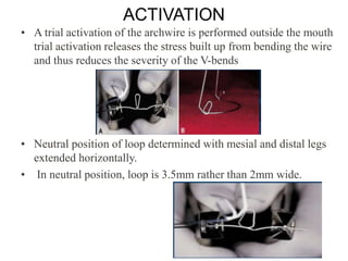ANTERIOR RETRACTION MECHANICs in orthodonticsS 1.pptx