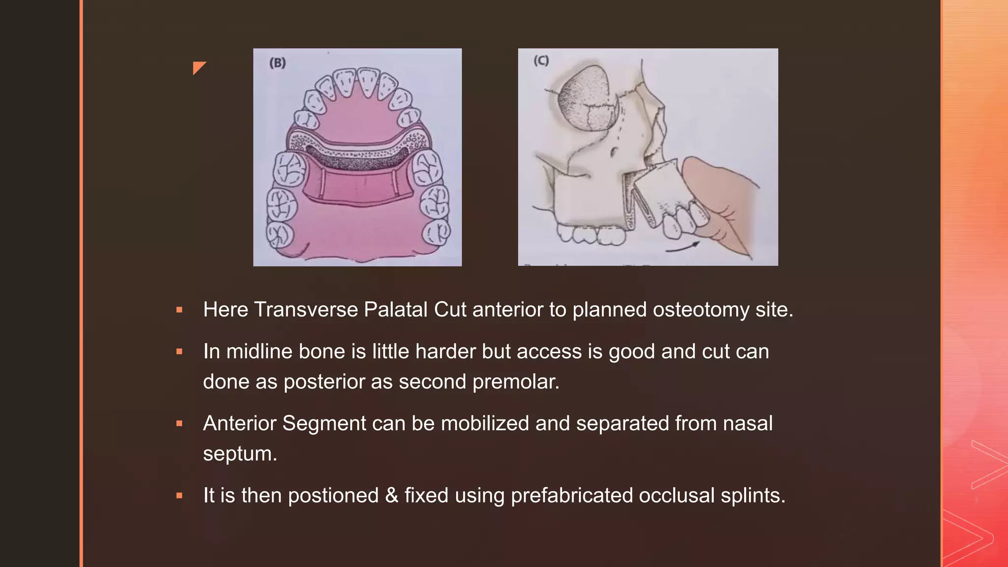 ANTERIOR SEGMENTAL MAXILLARY OSTEOTOMY.pptx