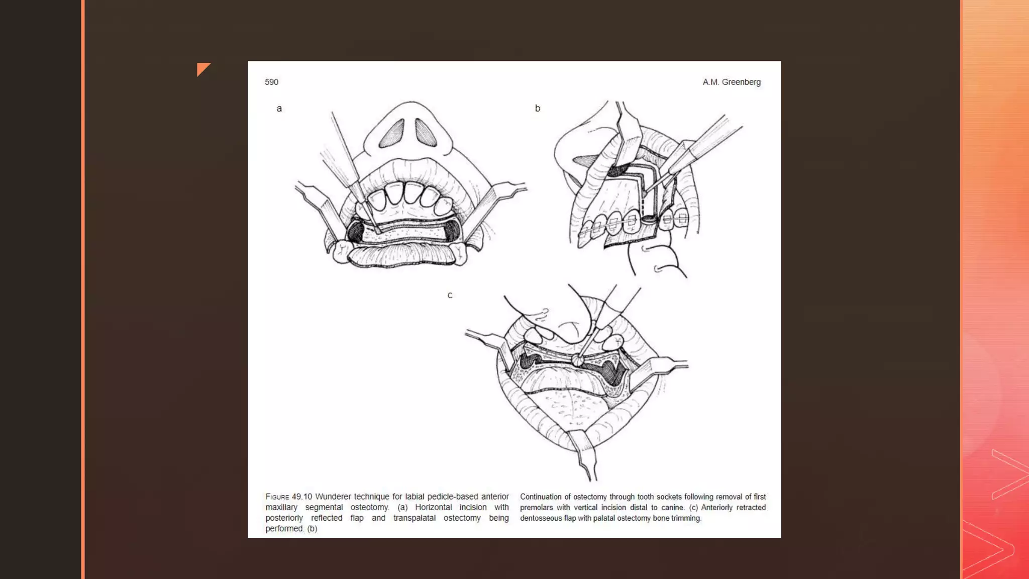 ANTERIOR SEGMENTAL MAXILLARY OSTEOTOMY.pptx