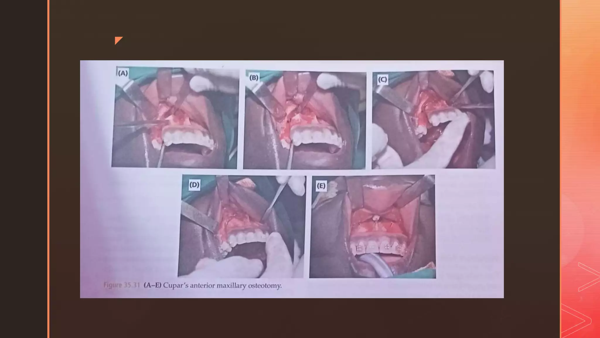 ANTERIOR SEGMENTAL MAXILLARY OSTEOTOMY.pptx