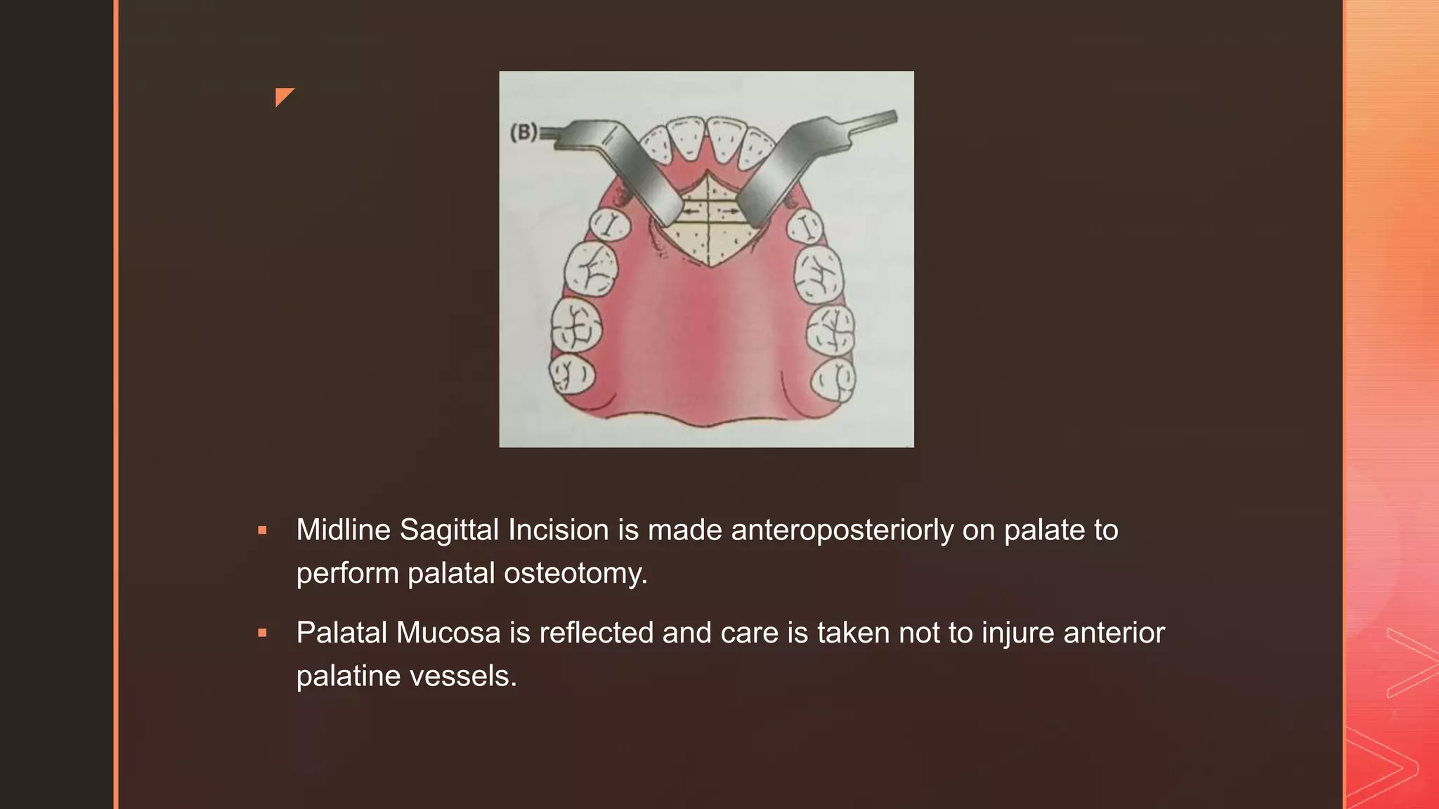 ANTERIOR SEGMENTAL MAXILLARY OSTEOTOMY.pptx