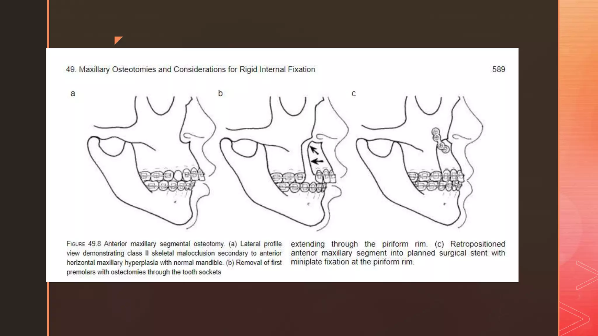 ANTERIOR SEGMENTAL MAXILLARY OSTEOTOMY.pptx