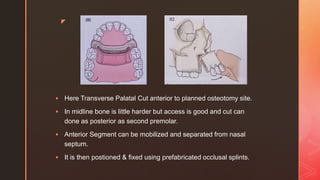 ANTERIOR SEGMENTAL MAXILLARY OSTEOTOMY.pptx