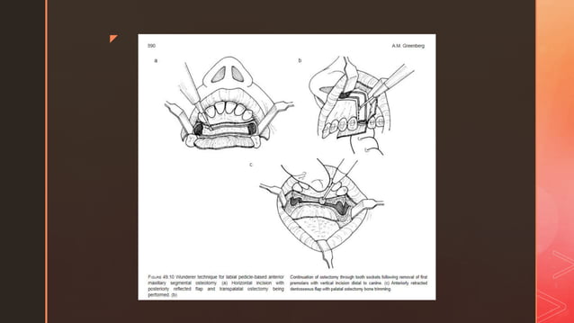 ANTERIOR SEGMENTAL MAXILLARY OSTEOTOMY.pptx
