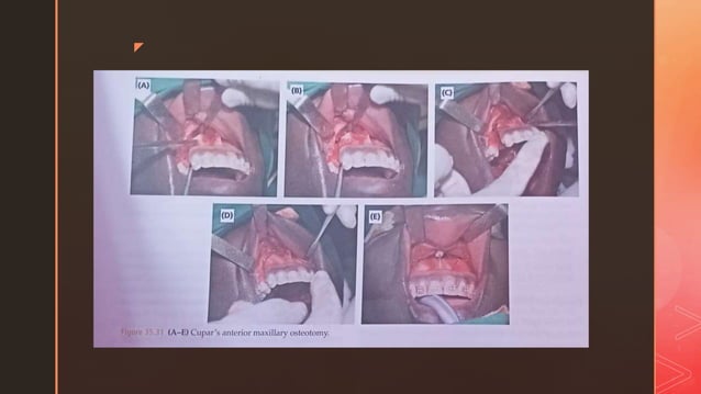 ANTERIOR SEGMENTAL MAXILLARY OSTEOTOMY.pptx