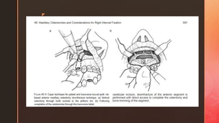 ANTERIOR SEGMENTAL MAXILLARY OSTEOTOMY.pptx