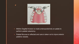 ANTERIOR SEGMENTAL MAXILLARY OSTEOTOMY.pptx