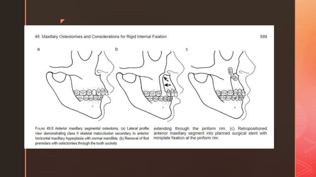 ANTERIOR SEGMENTAL MAXILLARY OSTEOTOMY.pptx