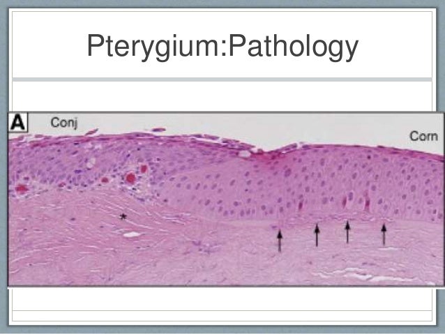 Anterior Segment: Pterygium