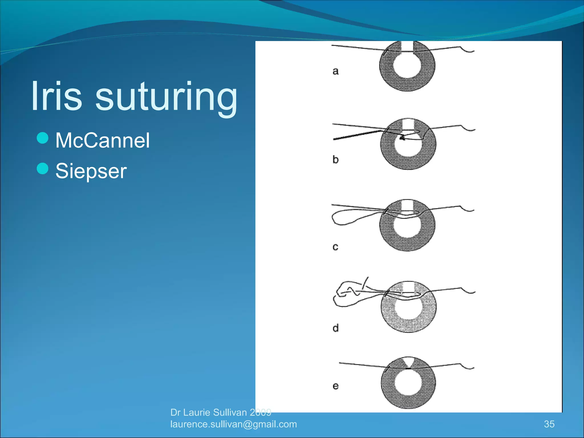 Anterior segment trauma ranzco 11112009 | PPT
