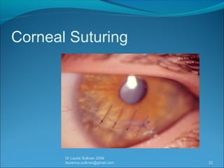 Anterior segment trauma ranzco 11112009 | PPT