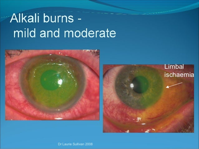 Anterior segment trauma ranzco 11112009