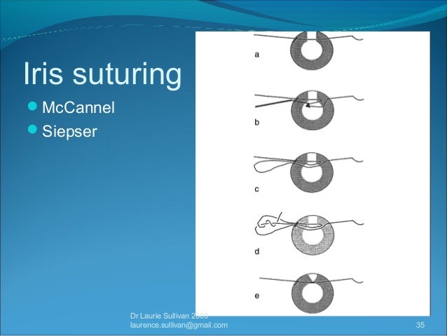 Anterior segment trauma ranzco 11112009