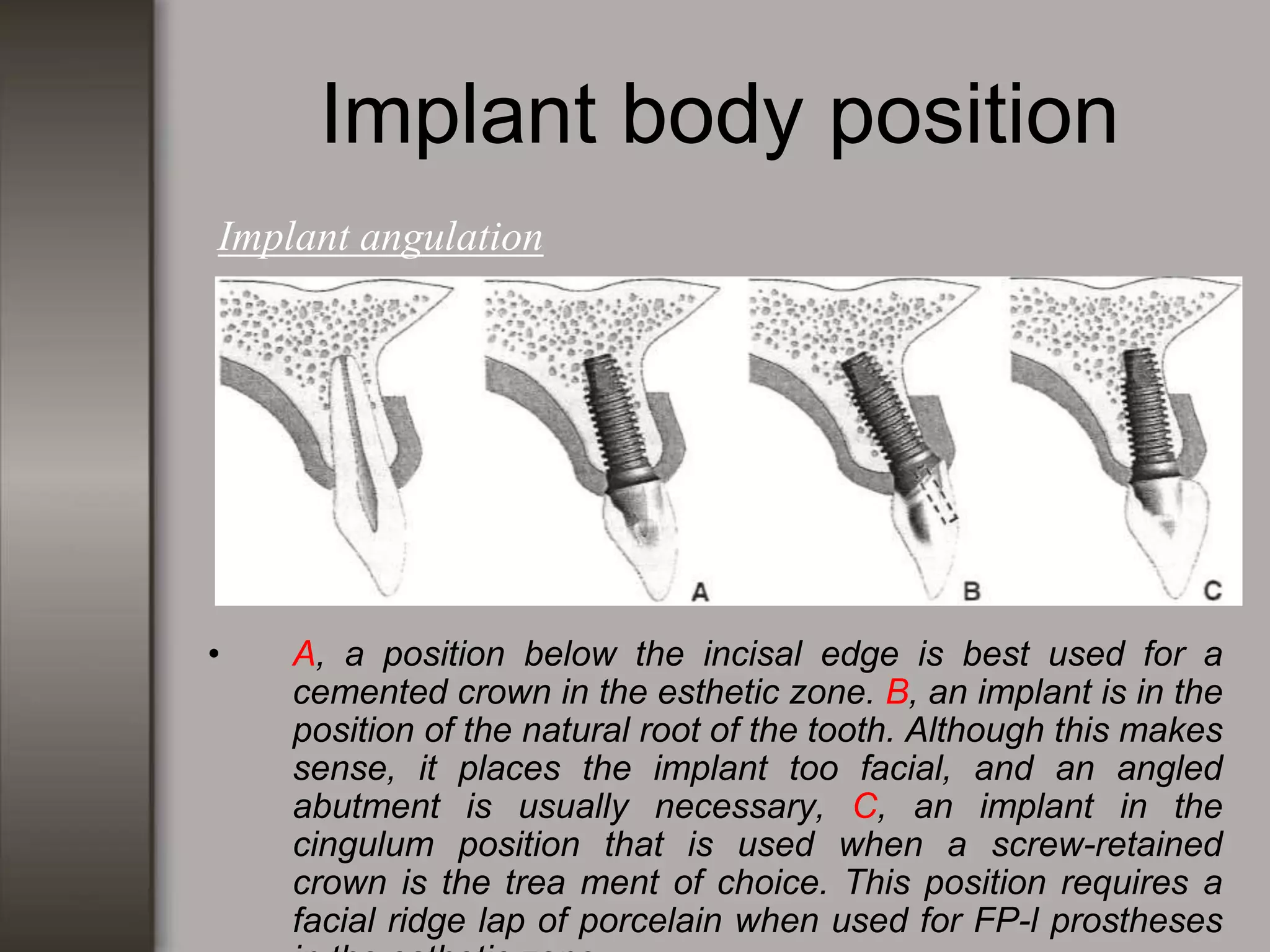 Anterior Single Implant Supported Restoration In Esthetic Zone | PPT
