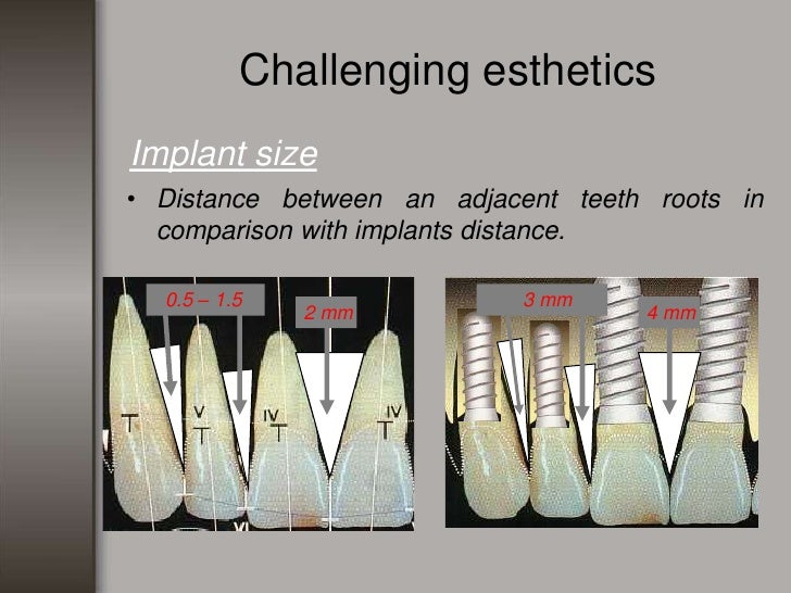 Anterior Single Implant Supported Restoration In Esthetic Zone
