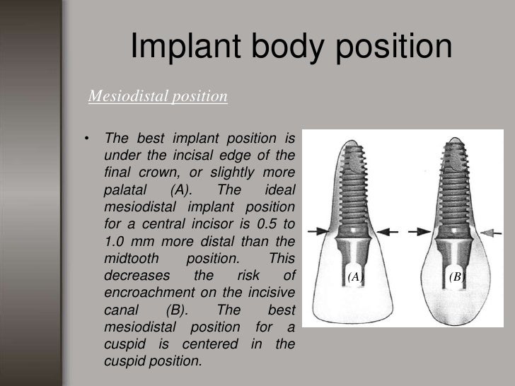 Anterior Single Implant Supported Restoration In Esthetic Zone