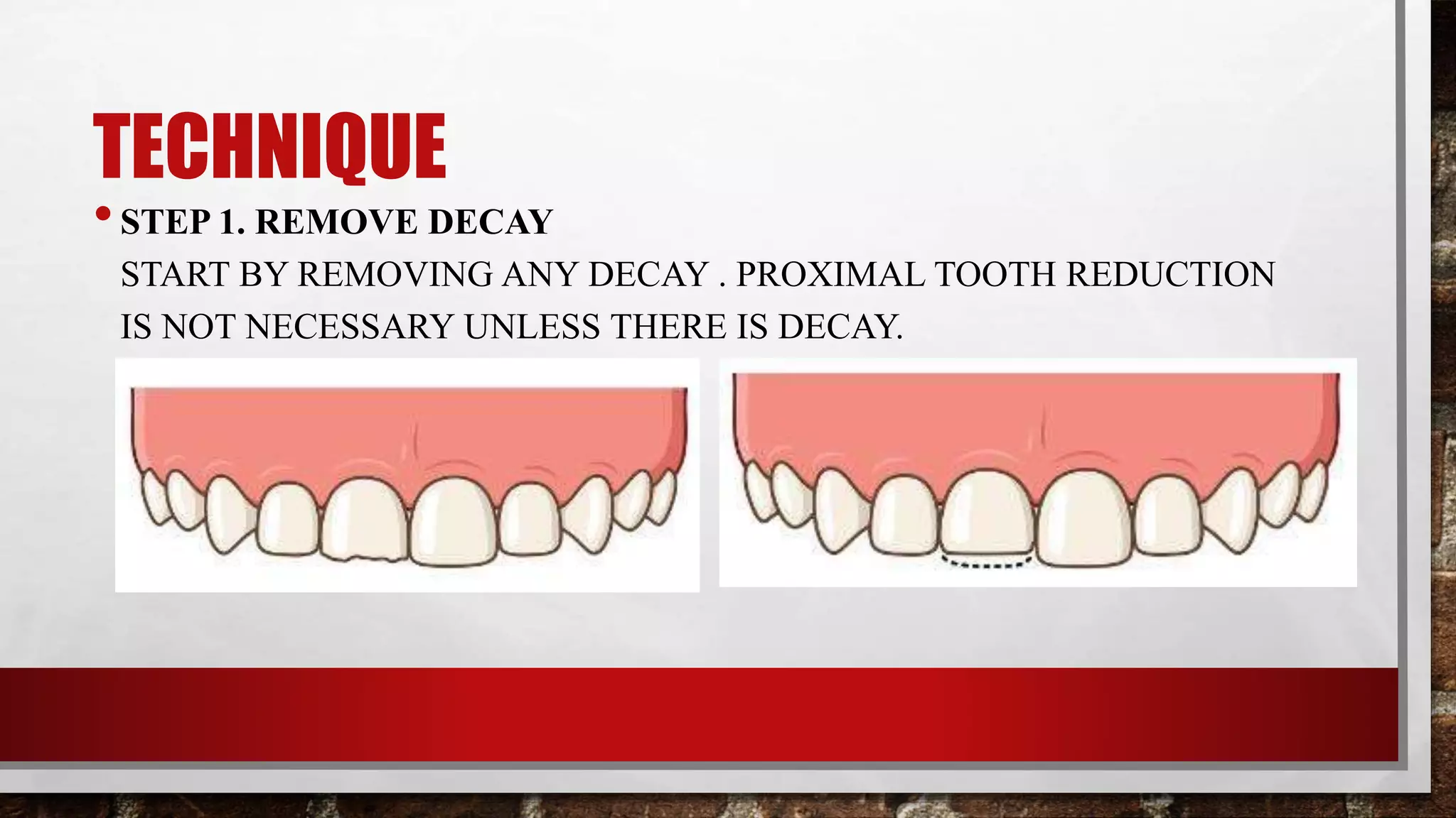 Anterior strip crown | PPTX