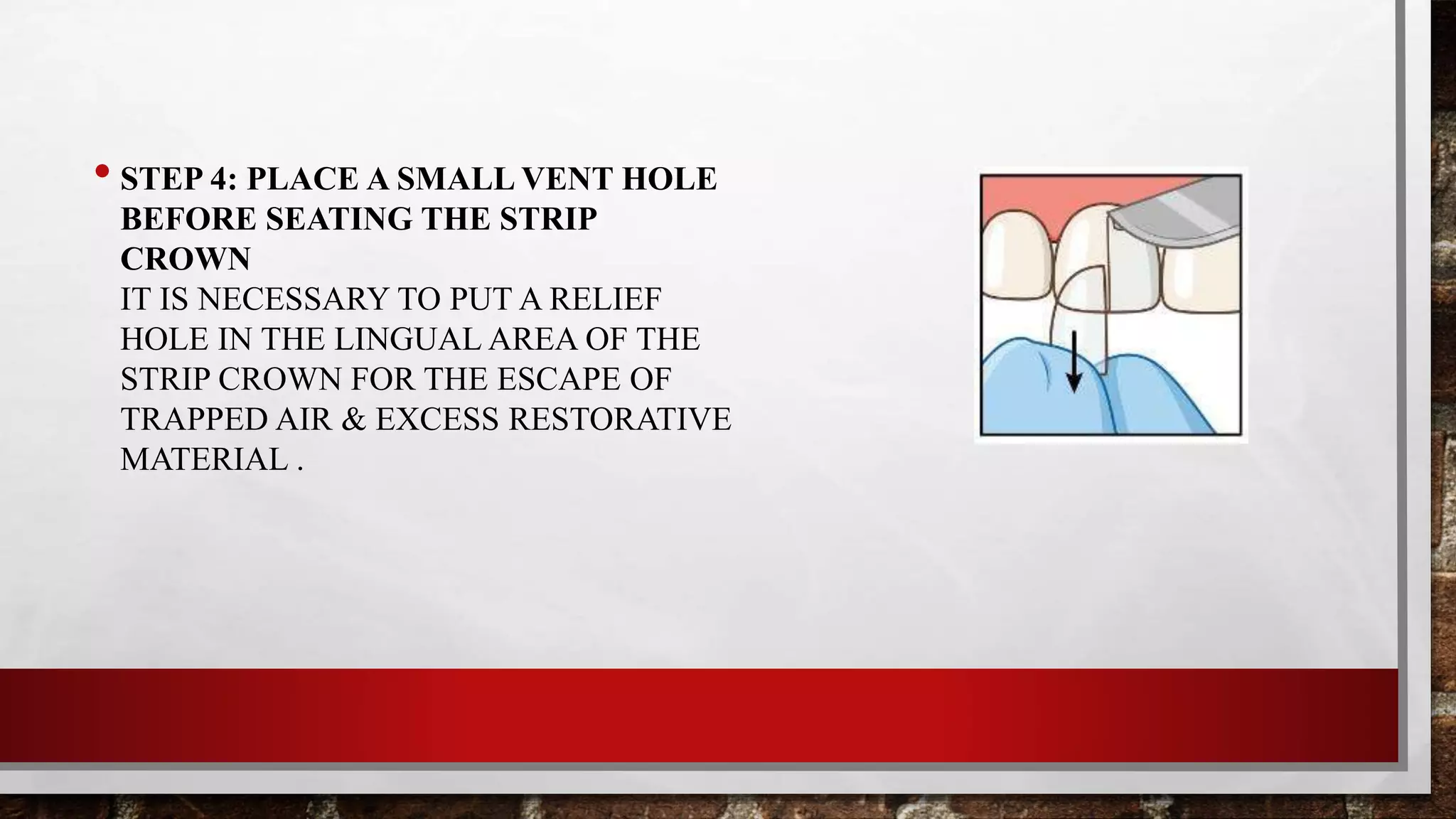 Anterior strip crown | PPTX
